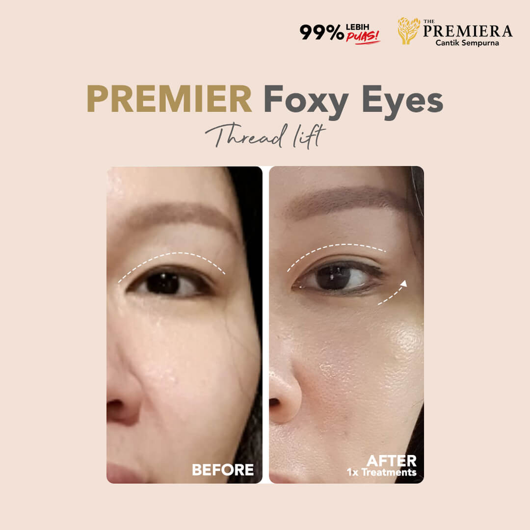PREMIER Foxy Eyes Threadlift | Premiera Skincare